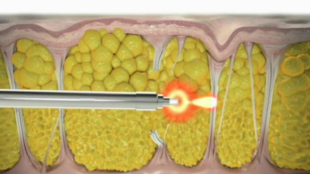 Laser procedure promises to get rid of cellulite in one treatment ...